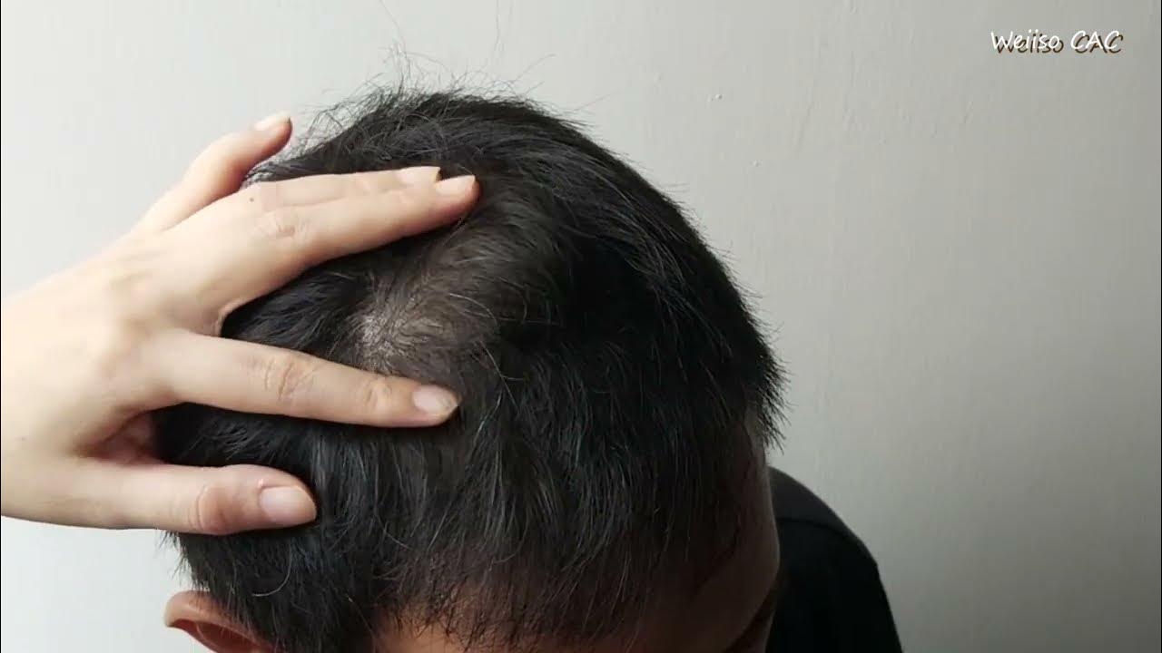 Holiday Satisfying Relaxing - Cabut Uban #3 Saat Liburan - YouTube