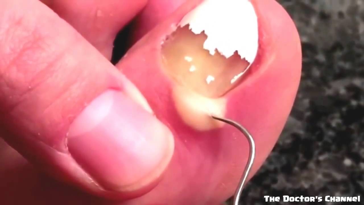extraction pus | Toenail Fungus Infection full Pus - YouTube