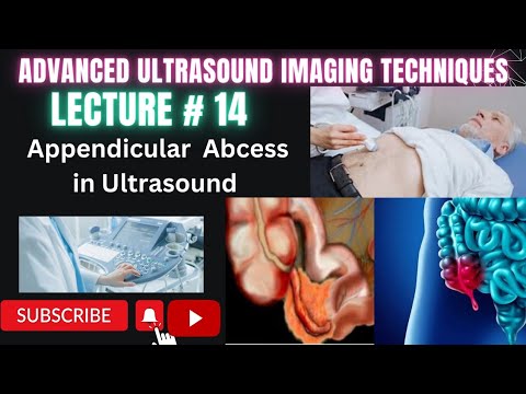 How to do appendix ultrasound Part 2 Appendicular abscess lecture 14 # ...