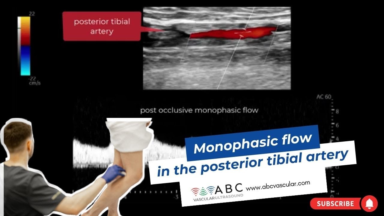 Monophasic flow in the posterior tibial artery | Ultrasound - YouTube