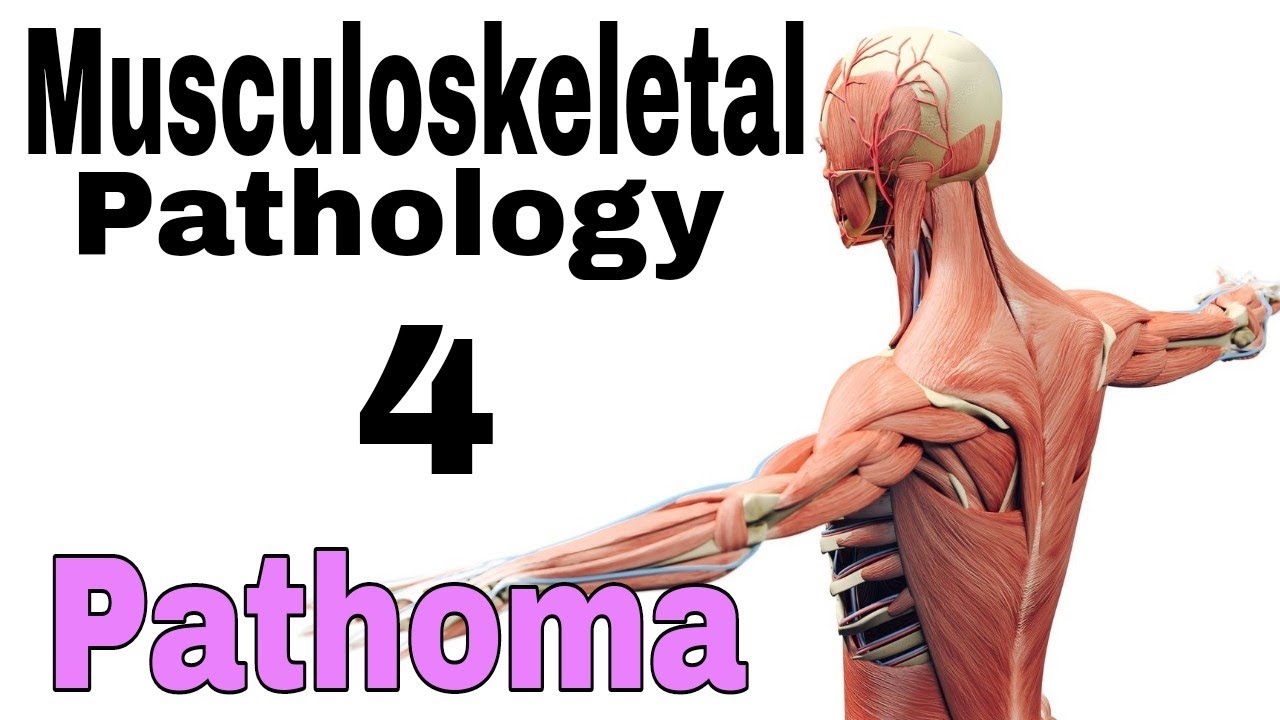 Musculoskeletal pathology 4 || #pathology || #pathoma || #muscles || # ...