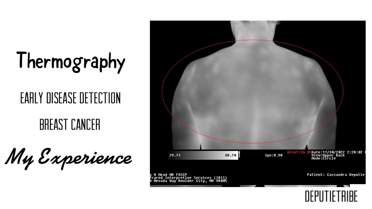 Thermography for early disease detection and breast cancer prevention ...