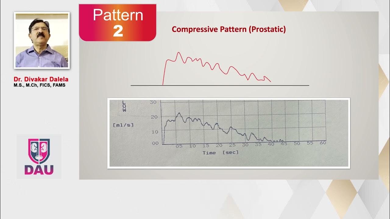 Uroflowmetry How to interpret Flow Patterns - YouTube