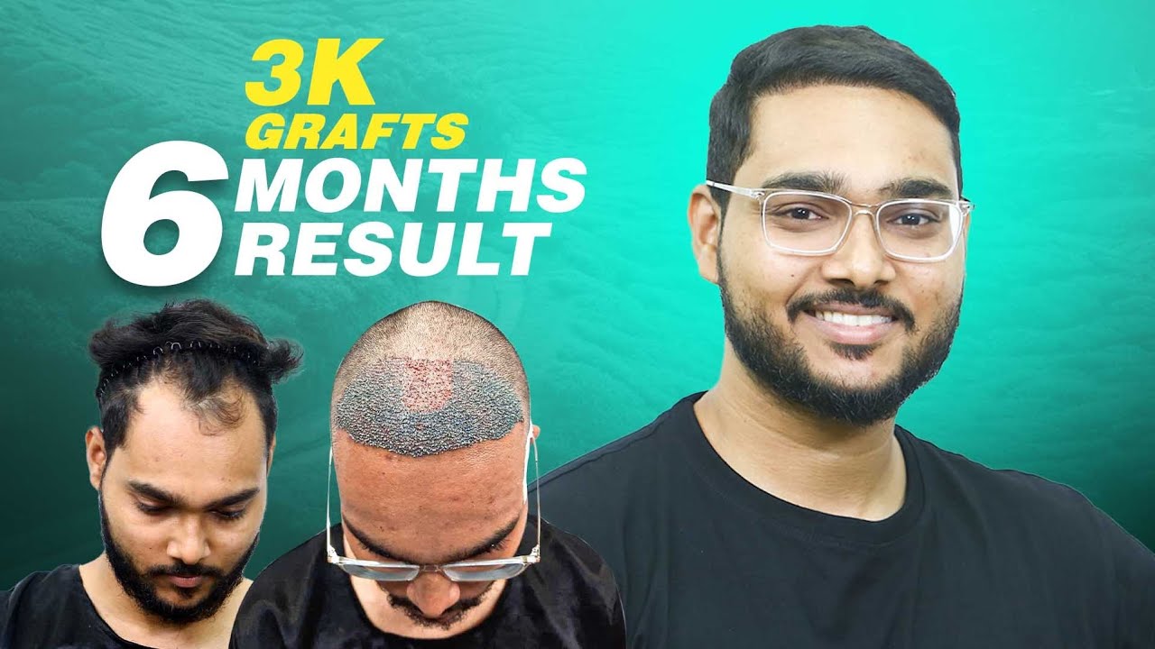 Hair Growth That Speaks for Itself 😍 | 6 Months Result | Siliguri | New ...