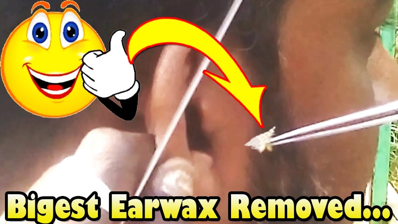 Largest Ear Plugs Chunk Removal / Really-Really Super Awesome Feeling ...
