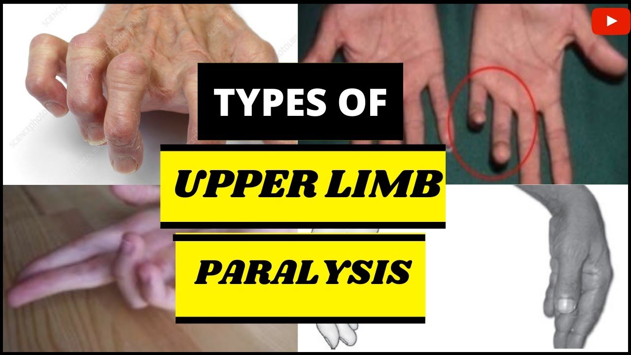 FMGE | UPPER LIMB PARALYSIS | PALSY | NERVE DAMAGE | NERVE INJURIES ...