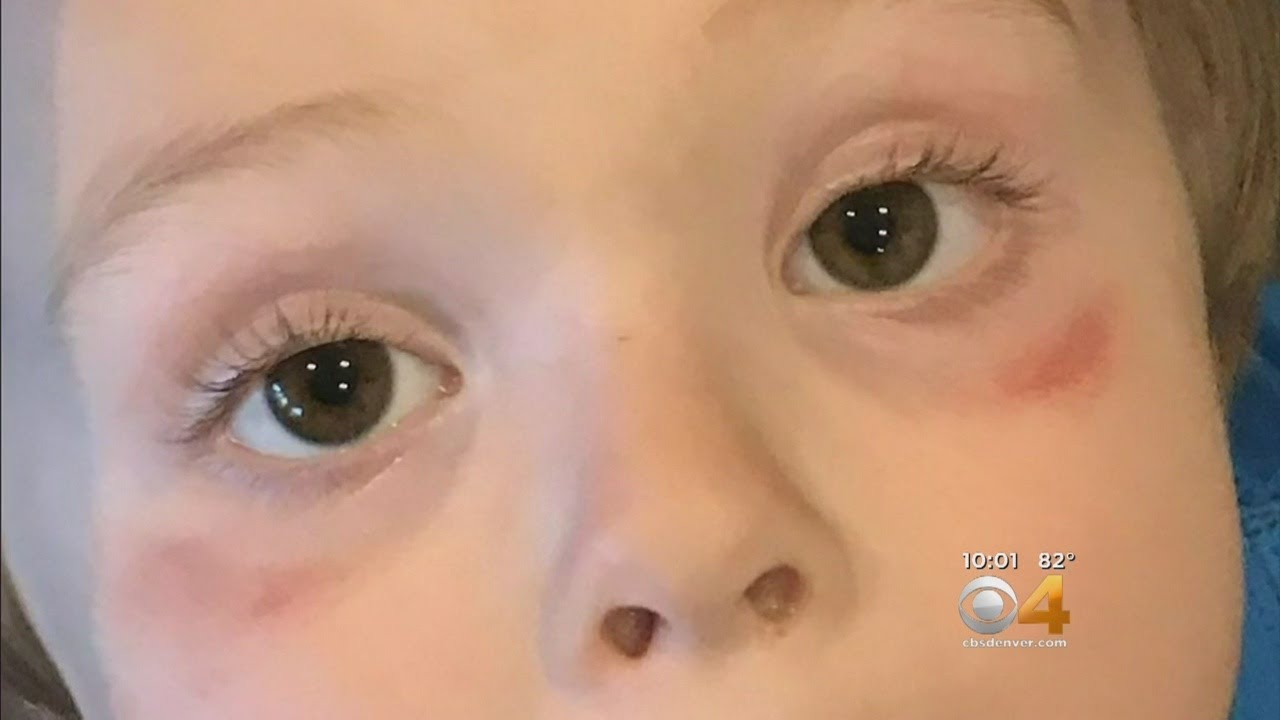 Lawsuit Claims Daycare Used Magic Eraser On Children's Faces - YouTube