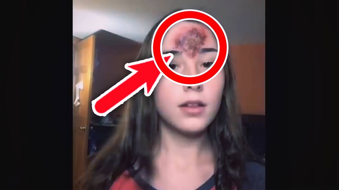 DISGUSTING Pimple Popping Moments 2021 - YouTube