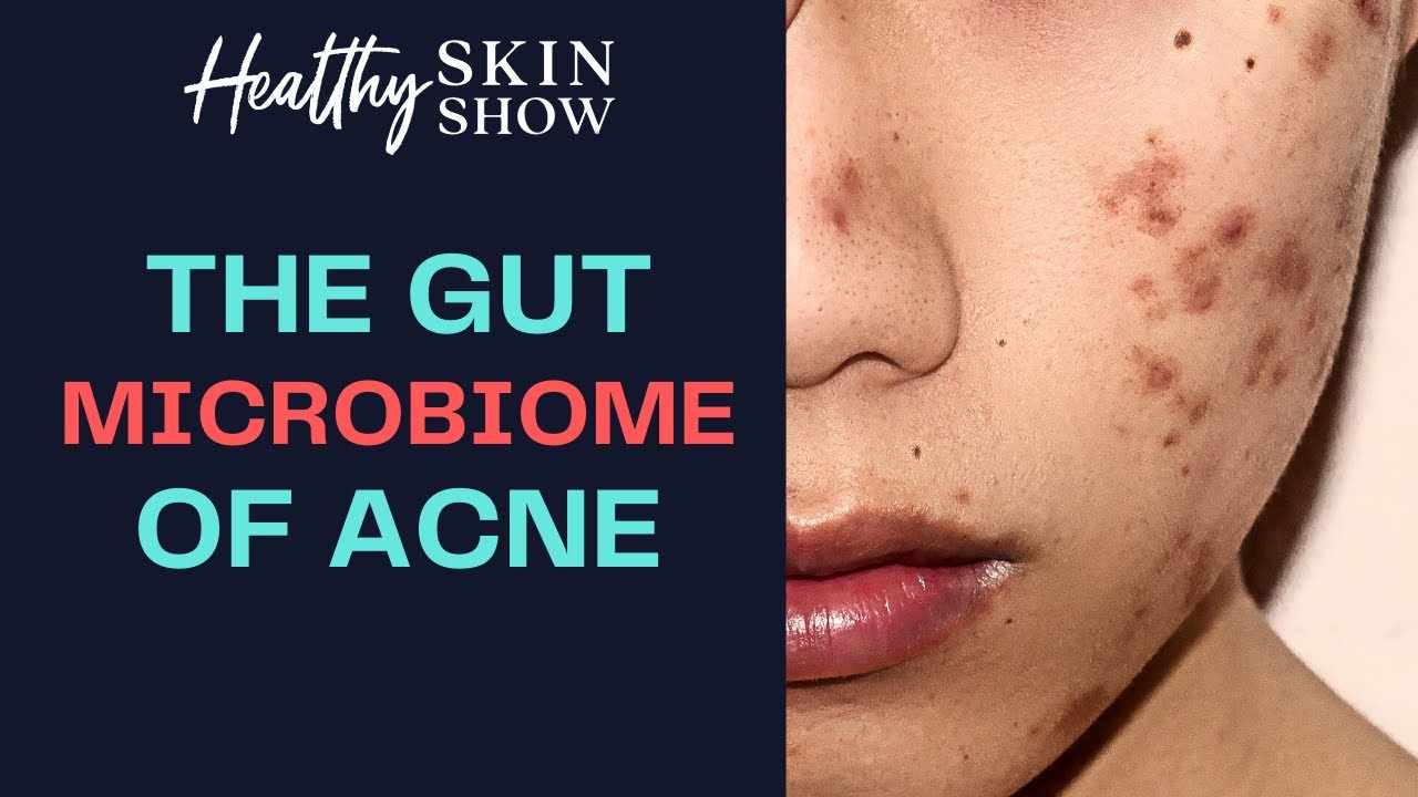The Gut Microbiome Of Acne [NEW RESEARCH] | Dr. Julie Greenberg - YouTube