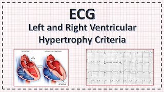Left and Right Ventricular Hypertrophy ECG criteria | L... | Doovi