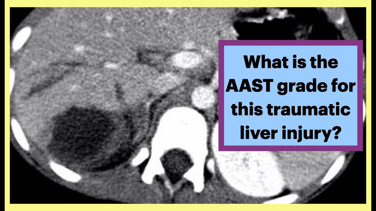 Grading Traumatic Liver Injury #radiology #liver #surgery - YouTube