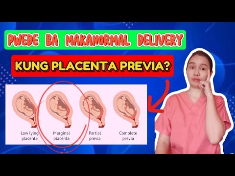 Pwede bang Maka Normal Delivery ang Placenta Previa?(Marginalis ...
