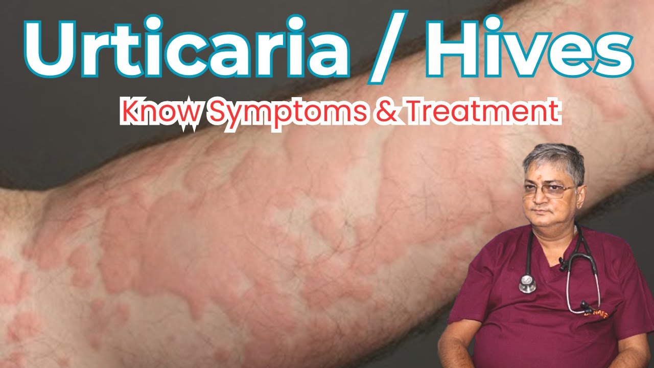 Urticaria | Hives Causes, Symptoms, Treatment | Skin Rash | Allergy ...