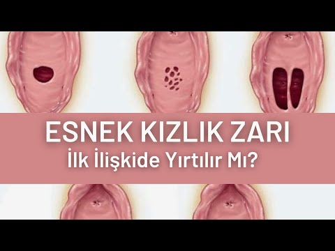 Esnek Kızlık Zarı Nedir? Esnek Kızlık Zarı İlk İlişkide Kanar Mı?