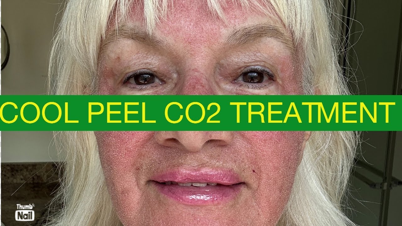 Cool peel procedure and how it feels ? - YouTube