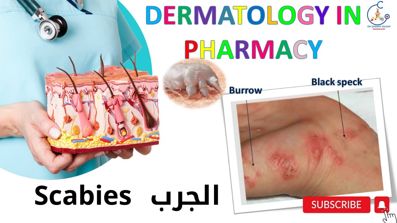 Otc Scabies Dermatology Course Parasitic Infestations Sarcoptes Scabiei الجرب Youtube