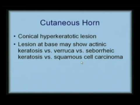 Cutaneous Horn - YouTube