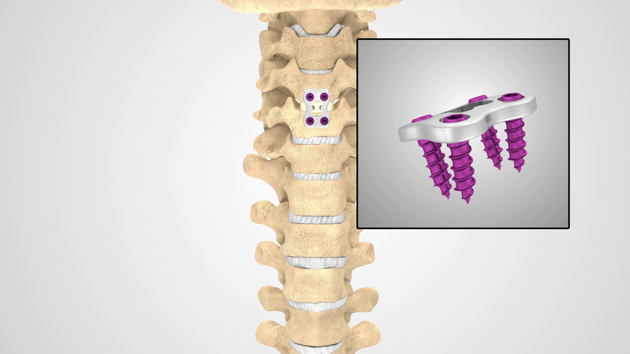ACDF Patient Education Animation (Spanish) 1 - YouTube