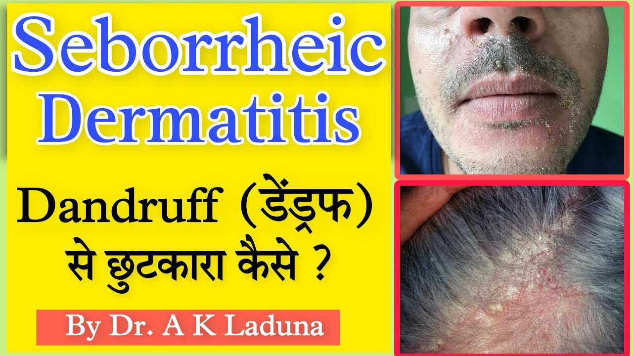 Dandruff, Seborrheic Dermatitis: Cause, Management and Homeopathic ...