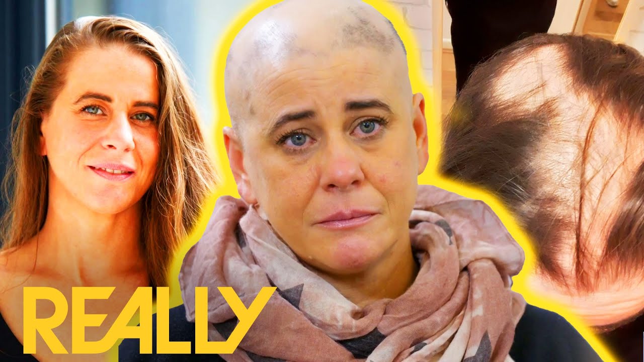 Woman With Alopecia Fears Her Condition May Be Permanent | The Hair ...