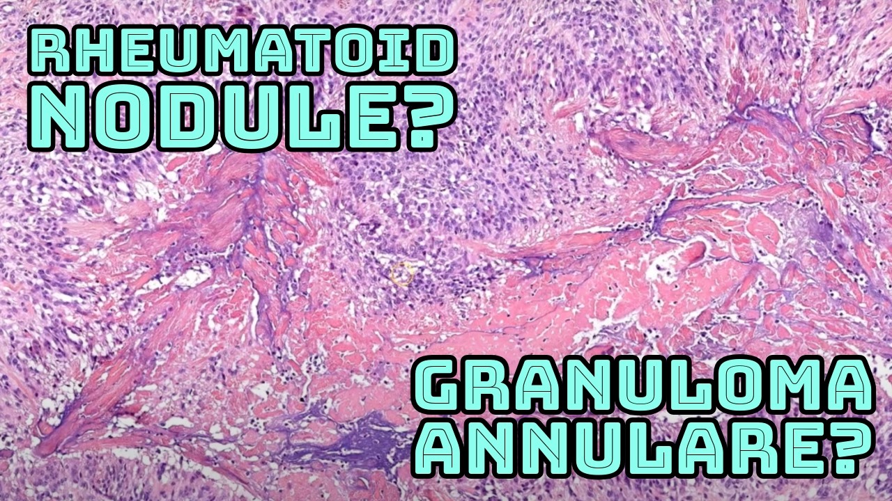 Rheumatoid nodule vs granuloma annulare (palisaded granulomatous ...