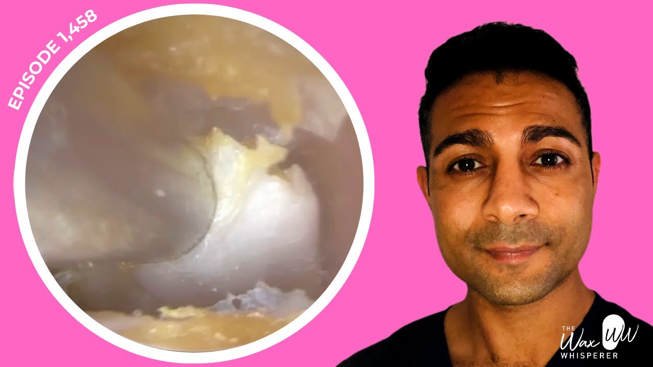 1,458 - Granular Myringitis Revealed After Removal of Sticky Dead Skin ...