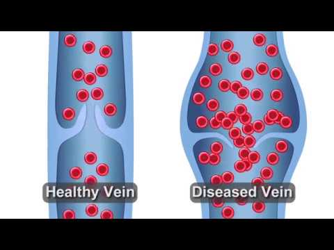 Dr. M. Joshua Berkowitz Discusses Chronic Venous Insufficiency - YouTube