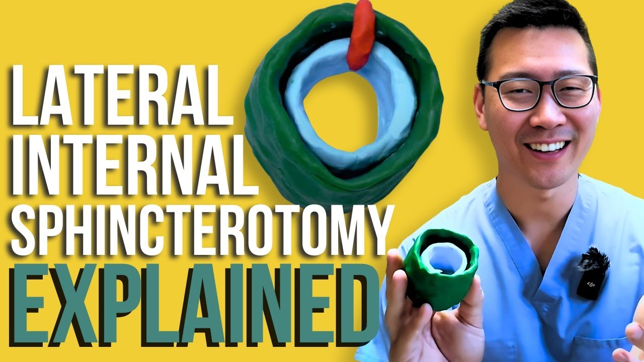 How the LIS is done! | Anal Fissure surgery - YouTube