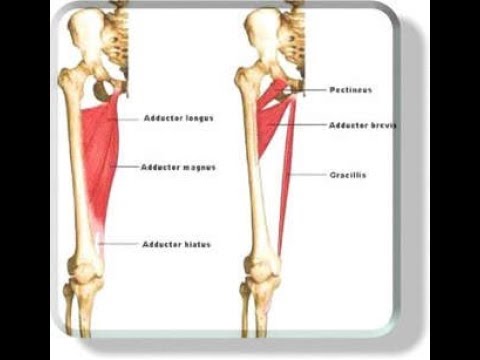Adductor tenotomy and closed reduction DDH رد خلع مفصل الفخذ الاطفال ...