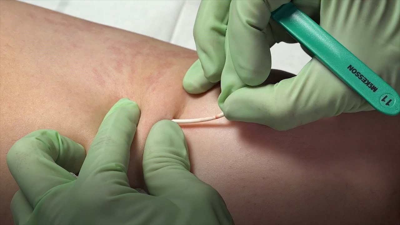 Removing a One Rod Implant , Teaching Short (HWs), English - Family ...