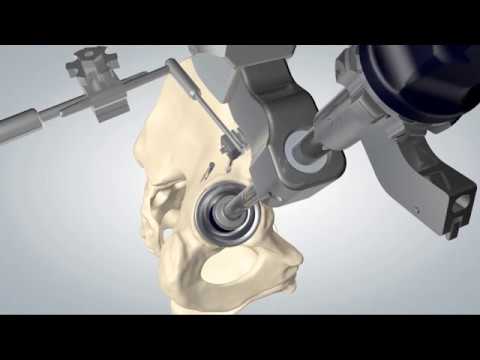 TSolution One® THA Cup Application Animation - YouTube