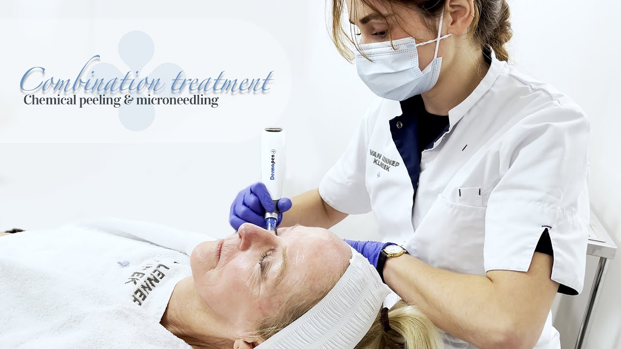 Combination Treatment - Chemical Peeling & Microneedling - YouTube