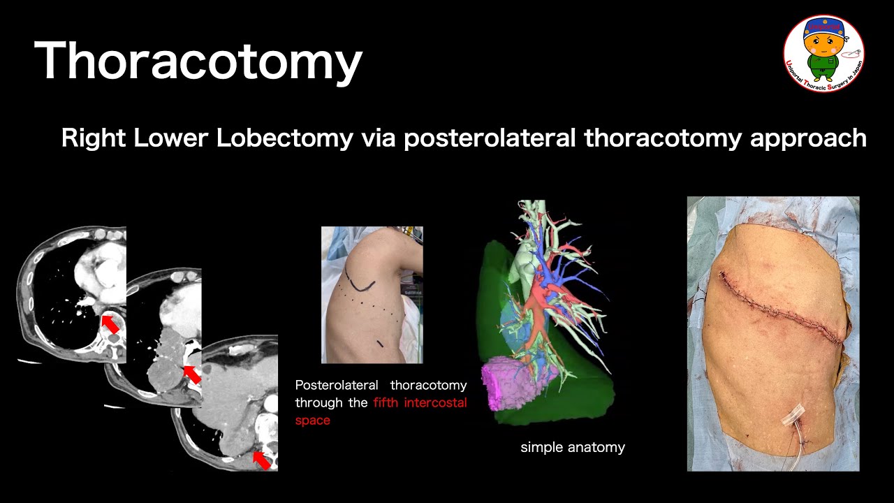 160】Thoracotomy, right lower lobectomy via posterolateral thoracotomy approach - YouTube