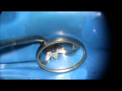 19 - Sterilising and drying root canal - YouTube
