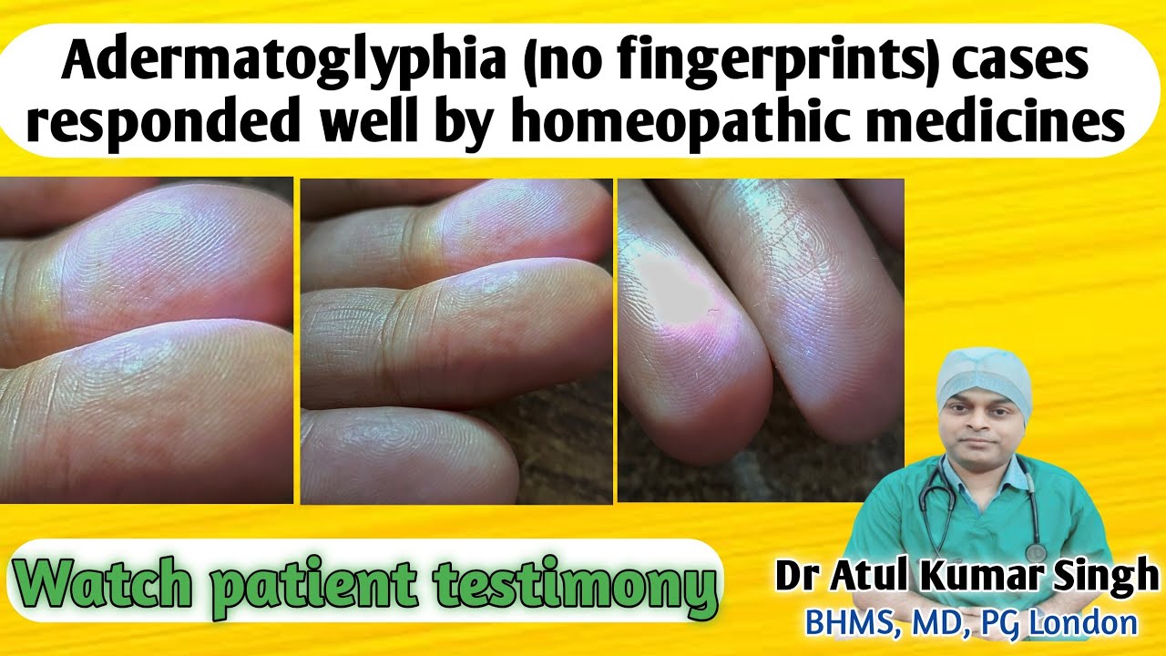 Adermatoglyphia Treatment Is Adermatoglyphia Curable फिंगरप्रिंट न
