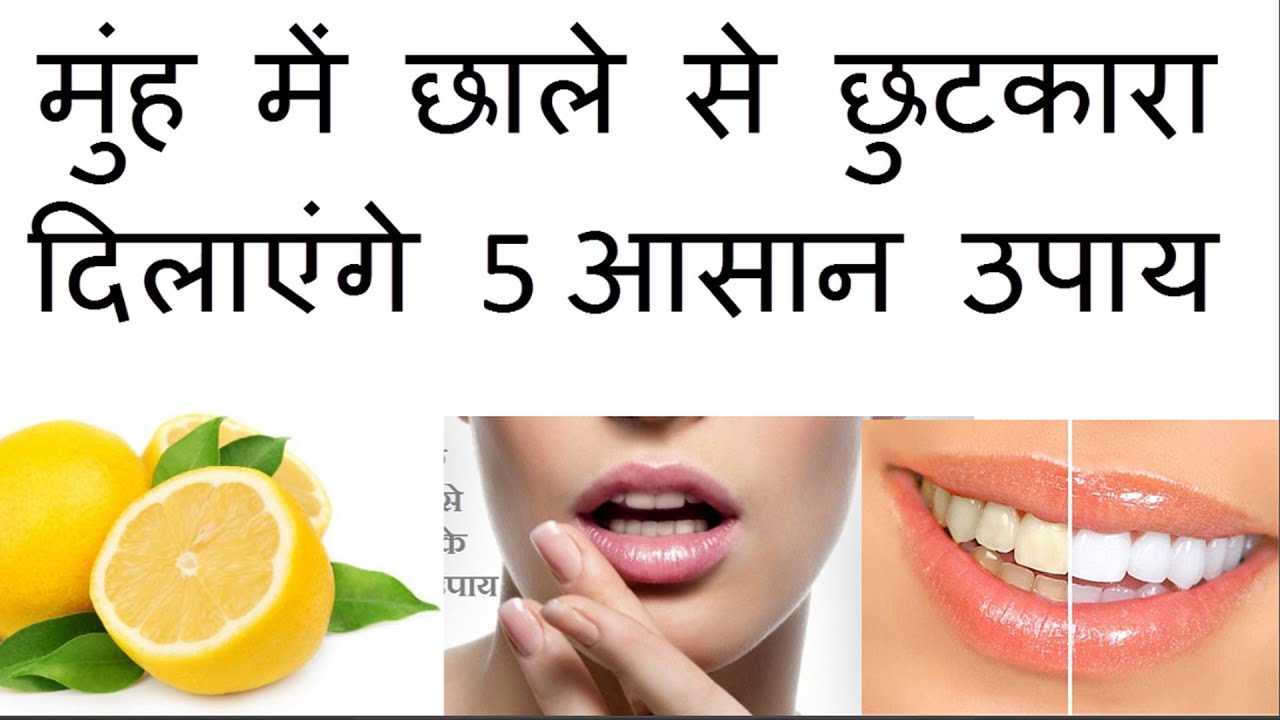 मुँह के छालो से राहत दिलाएंगे ये चमत्कारी पांच उपाय-Muh ke chhale theek ...