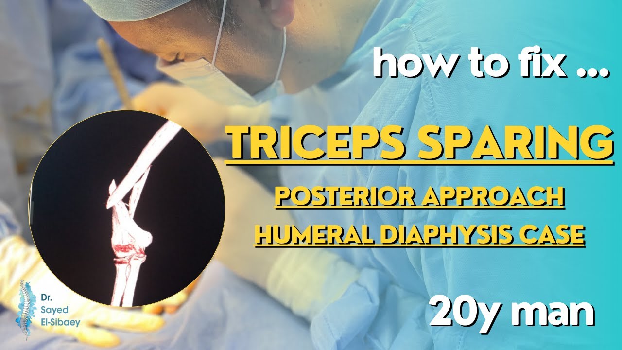 Triceps sparing Posterior Approach to the Humeral Diaphysis Case - YouTube