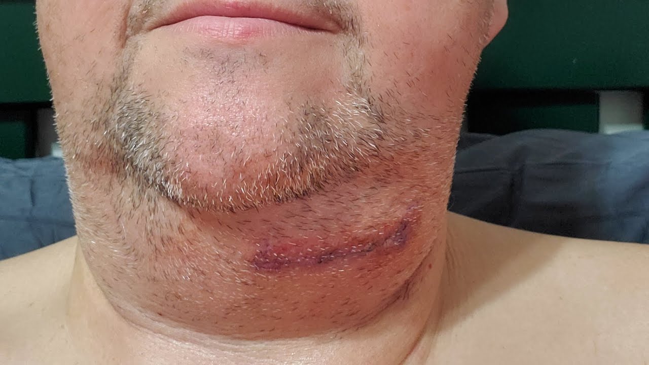 Day 2 of recovery from surgery to implant Inspire stimulator for sleep ...