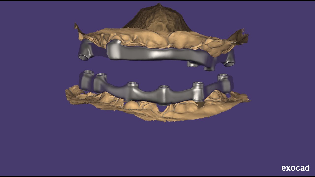 Upper & lower titanium bar designing for MU SCREW RETAINED IMPLANT in ...