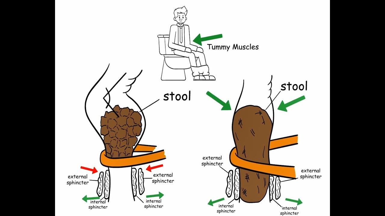 Normal Bowel Motions - YouTube