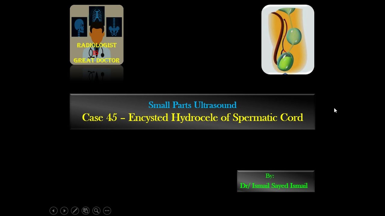 Ultrasound Case 45 - Encysted Hydrocele of Spermatic Cord - YouTube