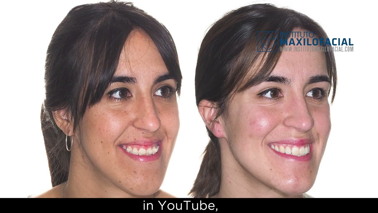 Jaw surgery Case # 94: Yolanda - Class III,long face, mandibular ...