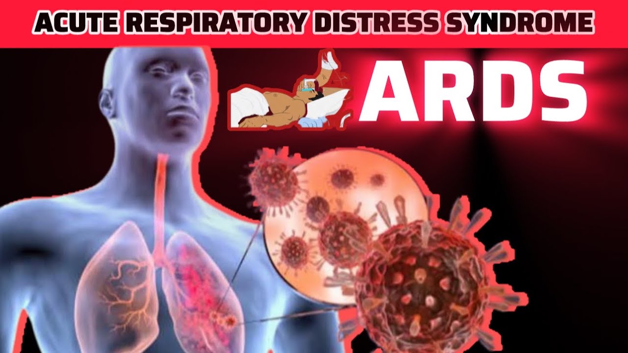 Acute Respiratory Distress Syndrome (ARDS) | Symptoms | Caused | Risk ...