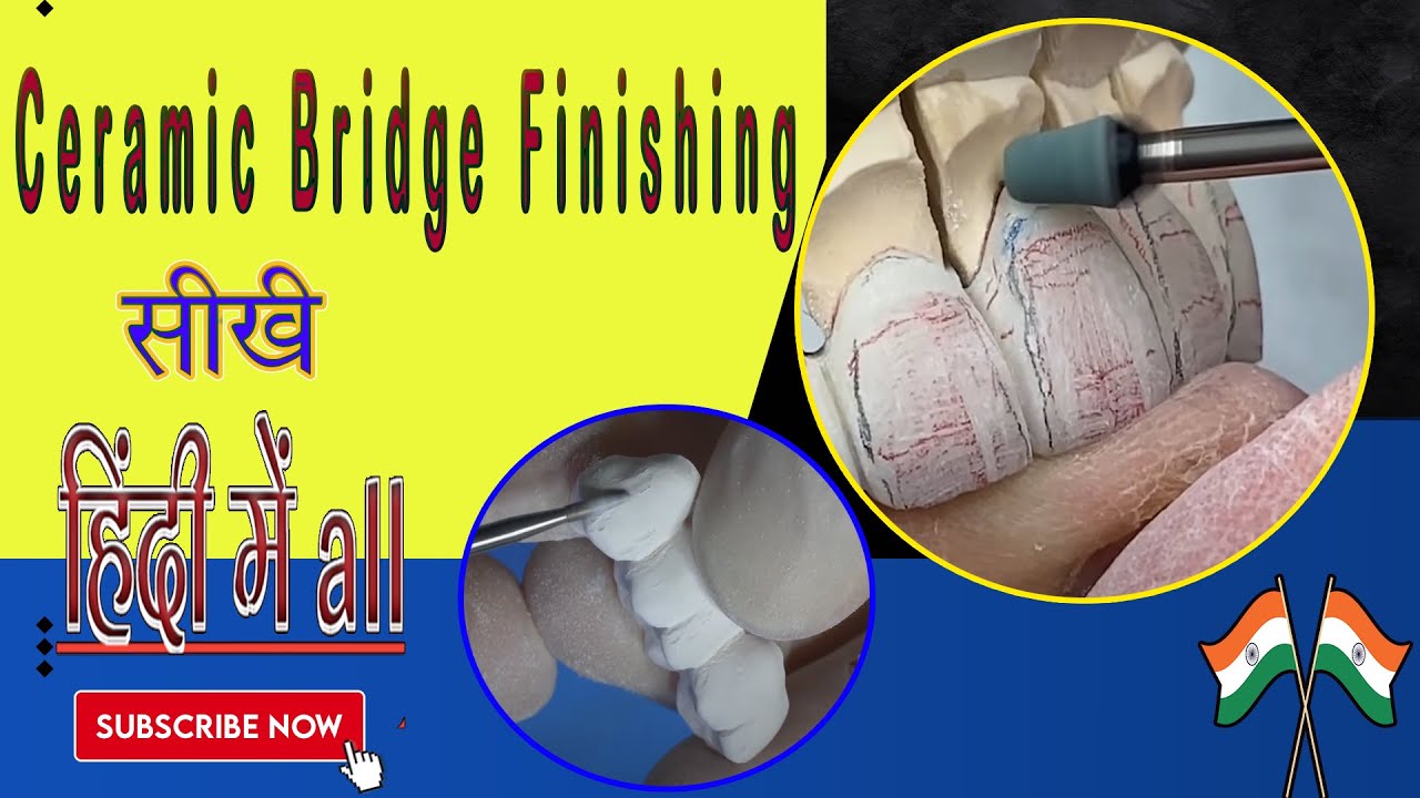Perfecting Dental Ceramic Bridge Finishing: Expert Tips and Techniques ...