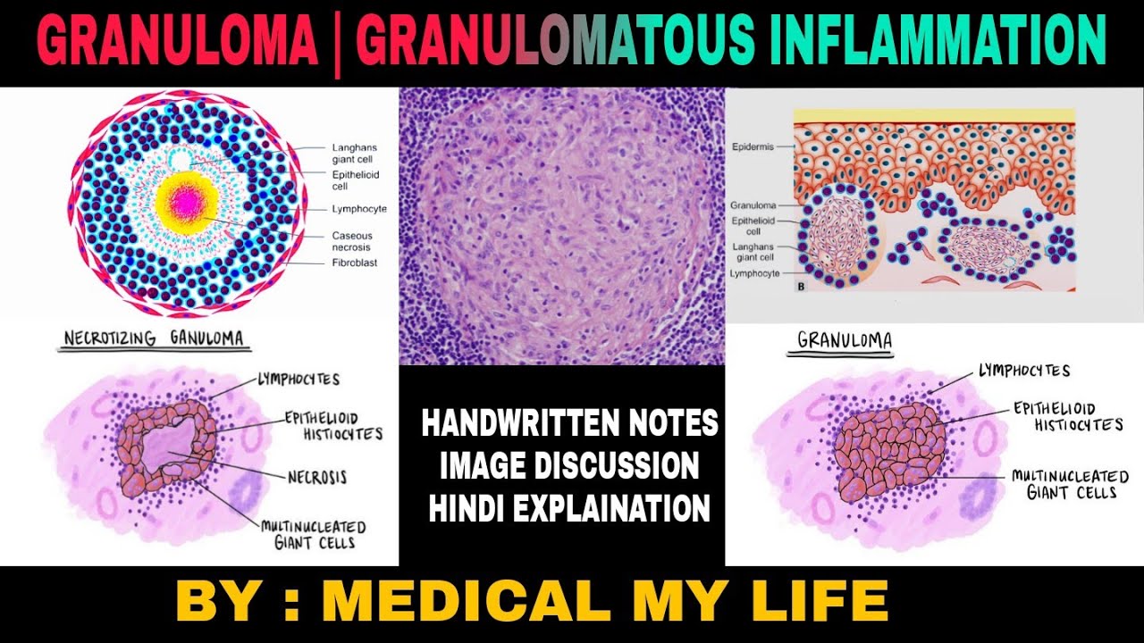What Is A Stump Granuloma at Amy Heyer blog