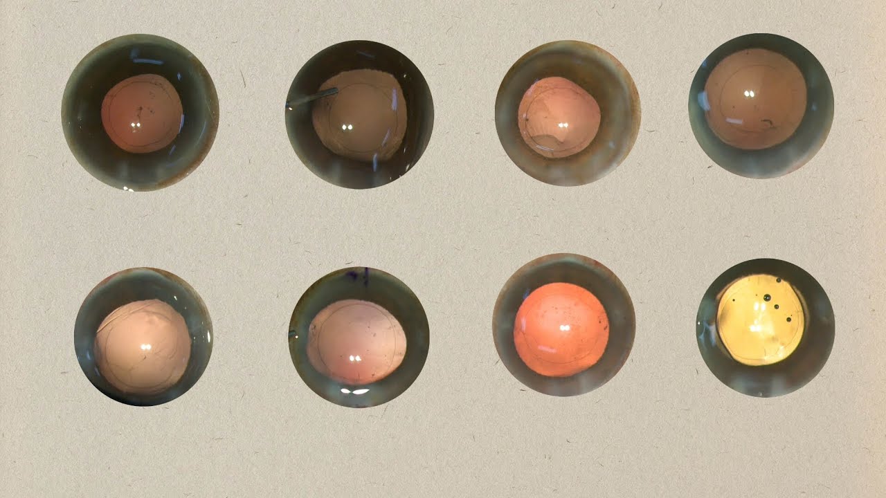 Femto Rhexis All the Time(Bidextrous Rhexis) - YouTube