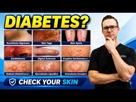 Doctor Reveals: 15 Skin Conditions Linked to Diabetes & Prediabetes