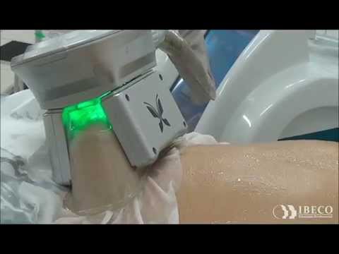Técnica de Criolipólise - YouTube