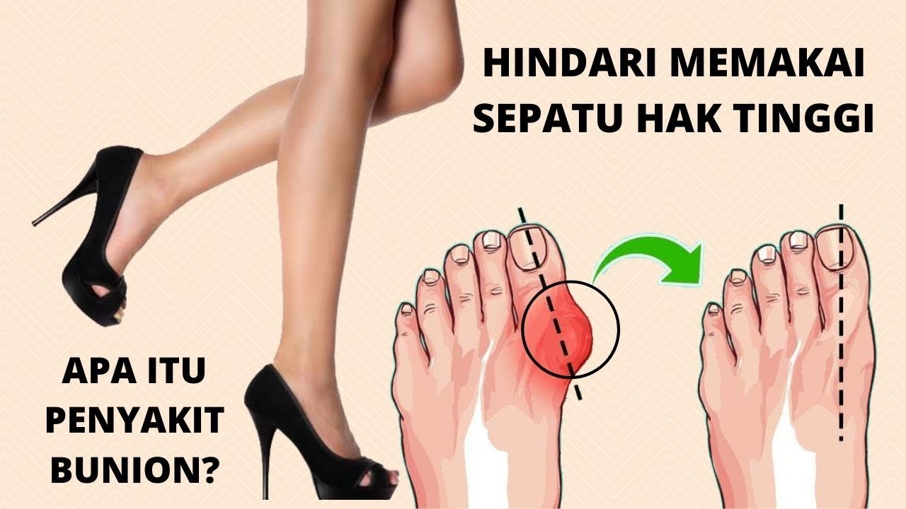 Jempol Ada Benjolan? Penyakit Ini Bisa Jadi Penyebabnya - YouTube