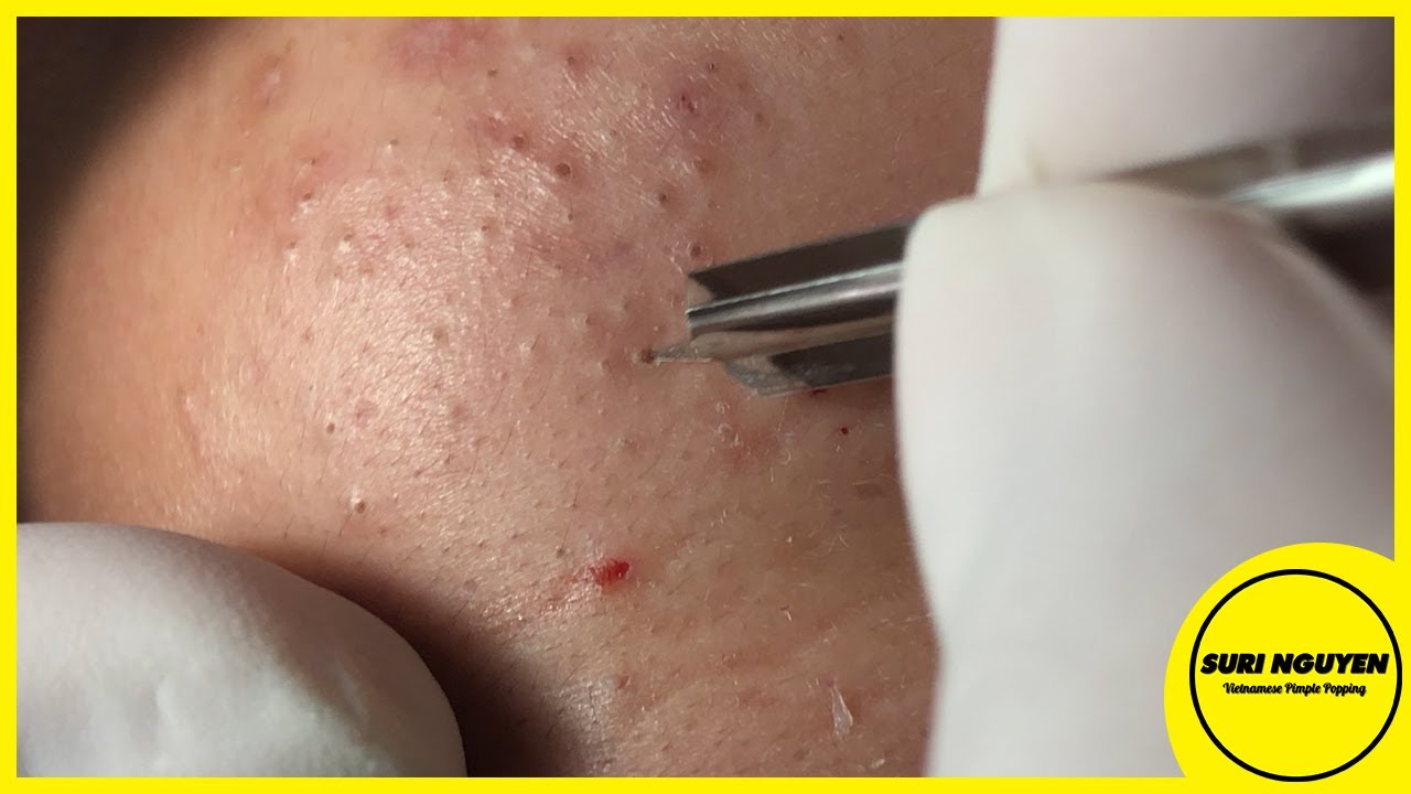 Suri Job 71: AWESOME INFLAMED BLACKHEADS EXTRACTION - YouTube